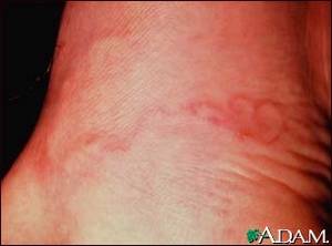 Roundworms In Humans Skin